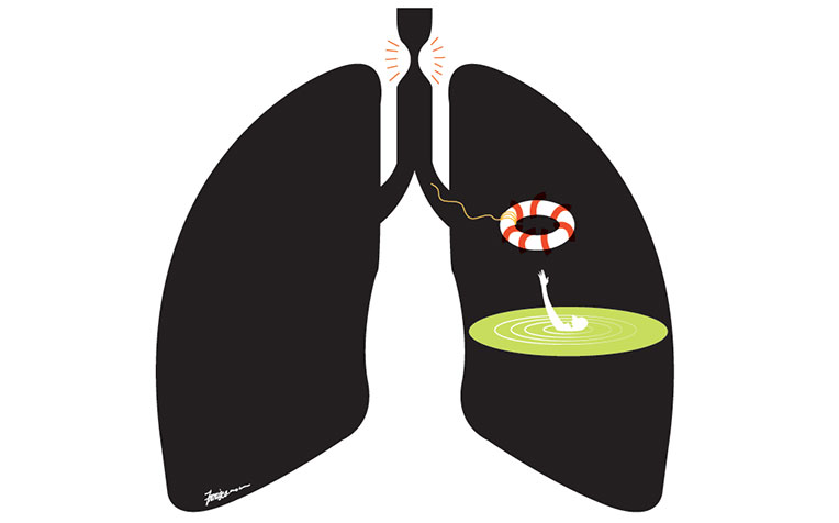 Hope for severe asthma patients - HealthXchange Hope for severe asthma patients - HealthXchange